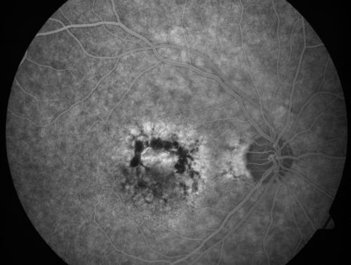 Pattern Dystrophy - Butterfly (Group 2) - Patterned Pigment Dystrophy ...