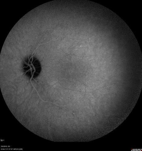 PIC with subretinal fibrosis - PIC which evolved into Subretinal ...